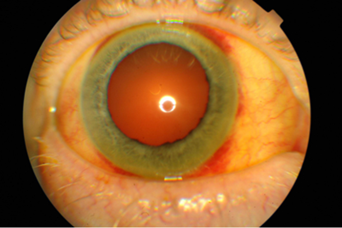 Acute dellen formation post trauma | Eye News