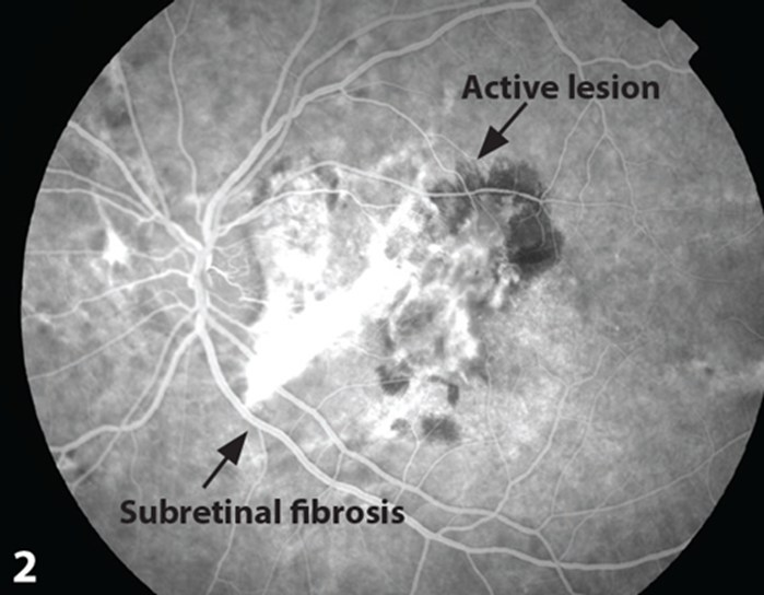 A patient report of pseudoxanthoma elasticum, angioid streaks and ...