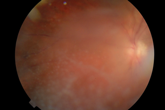 Acute retinal necrosis presumably caused by Epstein-Barr virus ...