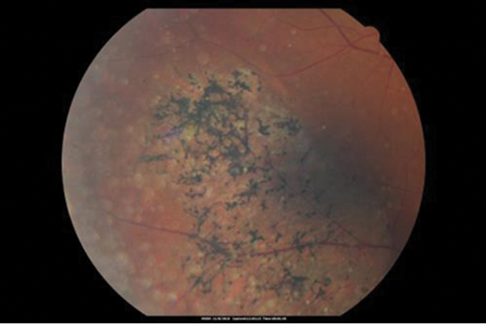 White dot syndromes | Eye News