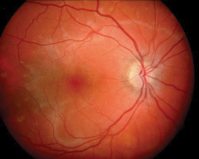 White dot syndromes | Eye News