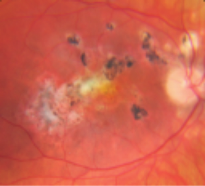 White dot syndromes | Eye News