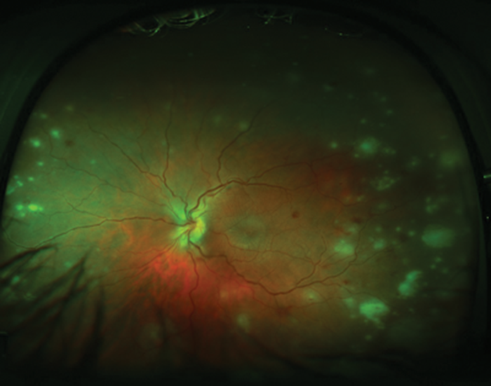 An unusual case of acute retinal necrosis | Eye News