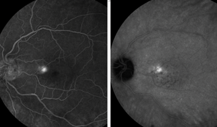 An unusual case of acute retinal necrosis | Eye News