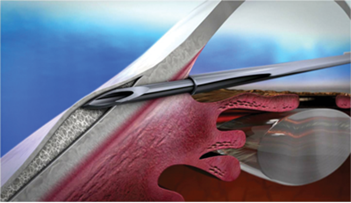 Improved efficacy expected with second-generation microinvasive ...