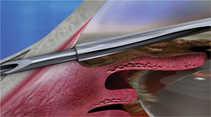 Improved efficacy expected with second-generation microinvasive ...