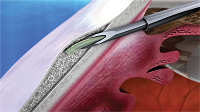Improved efficacy expected with second-generation microinvasive ...
