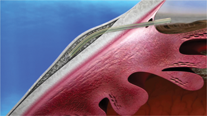 Improved efficacy expected with second-generation microinvasive ...