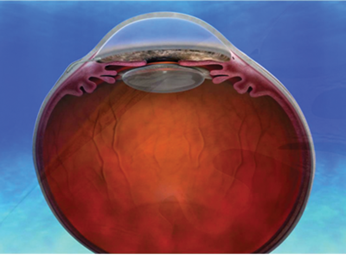 Improved efficacy expected with second-generation microinvasive ...