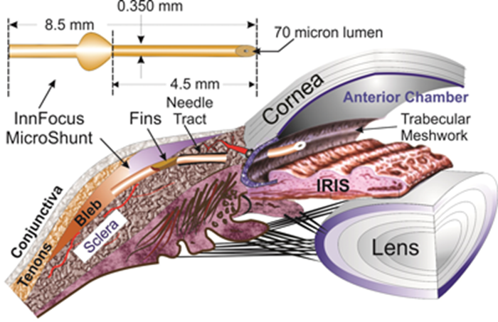 Improved efficacy expected with second-generation microinvasive ...