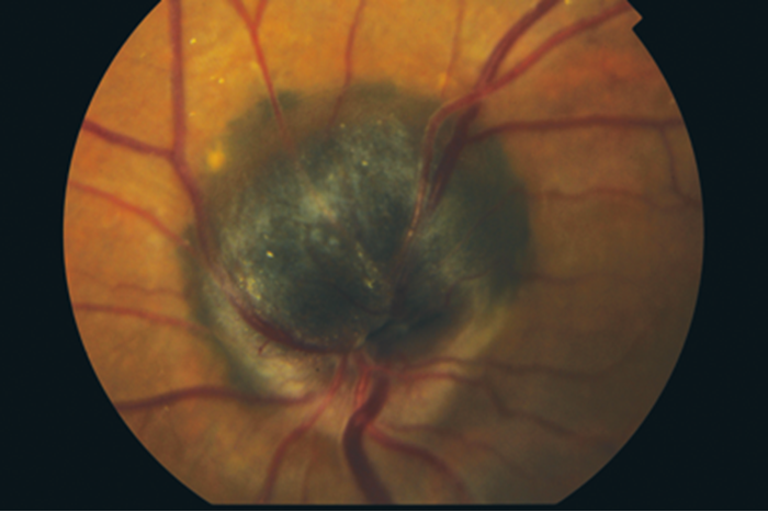 Melanocytoma of the optic disc | Eye News
