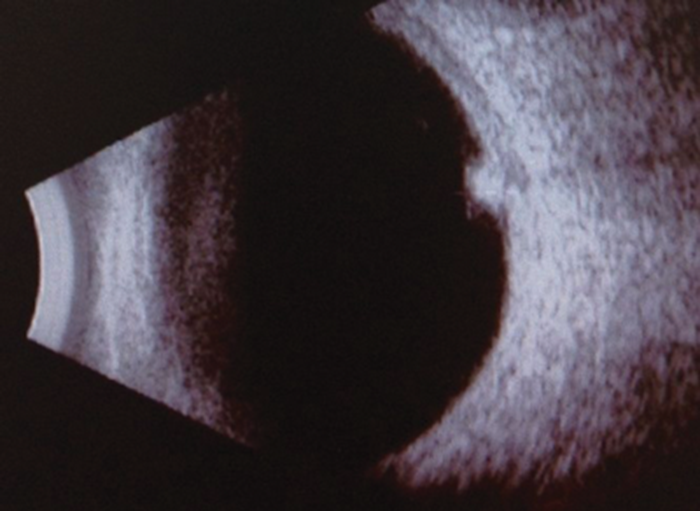 Melanocytoma of the optic disc | Eye News