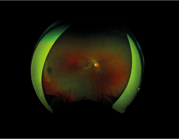 The past and the future for paediatric ophthalmology | Eye News
