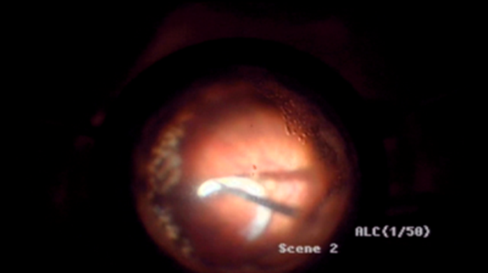 How a calcified Soemmerring ring was removed from the vitreous cavity ...