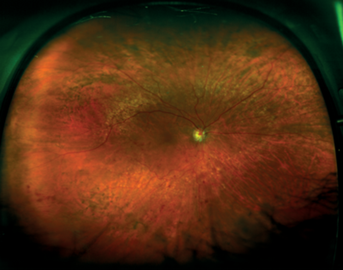 What’s next in retinal imaging? Faster, deeper and full-on | Eye News