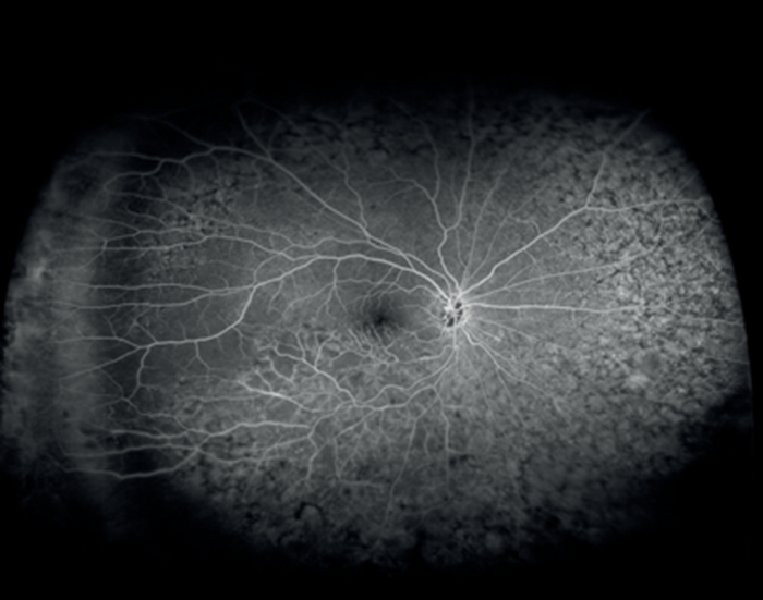 What’s next in retinal imaging? Faster, deeper and full-on | Eye News