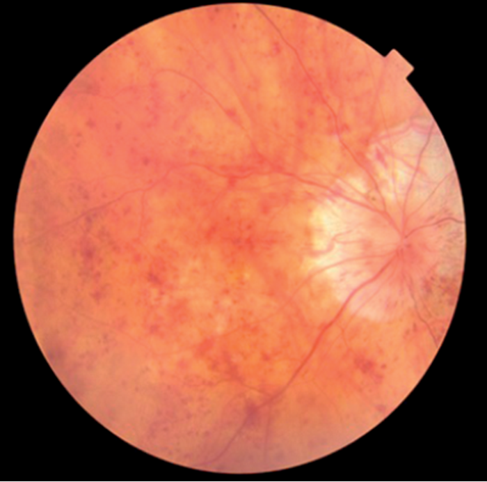 The management of retinal vein occlusions: a summary | Eye News