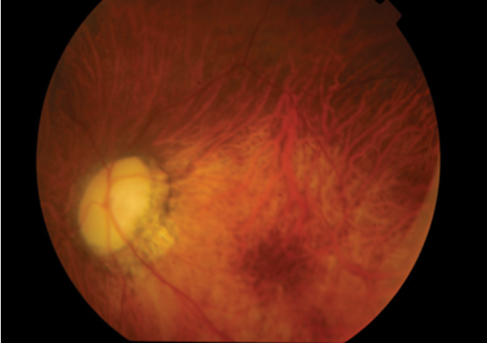 Cytomegalovirus retinitis post intravitreal triamcinolone in an ...