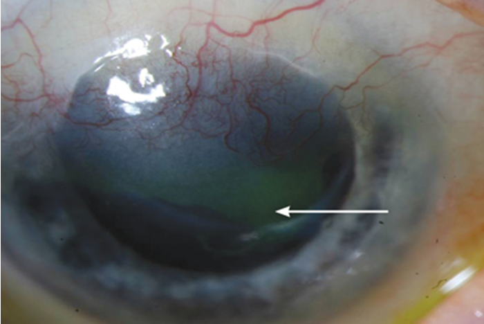 Therapy for limbal stem cell deficiency: cell fate after limbal stem ...
