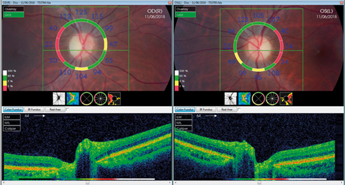 What not to miss in neuro-ophthalmology Part 2 | Eye News