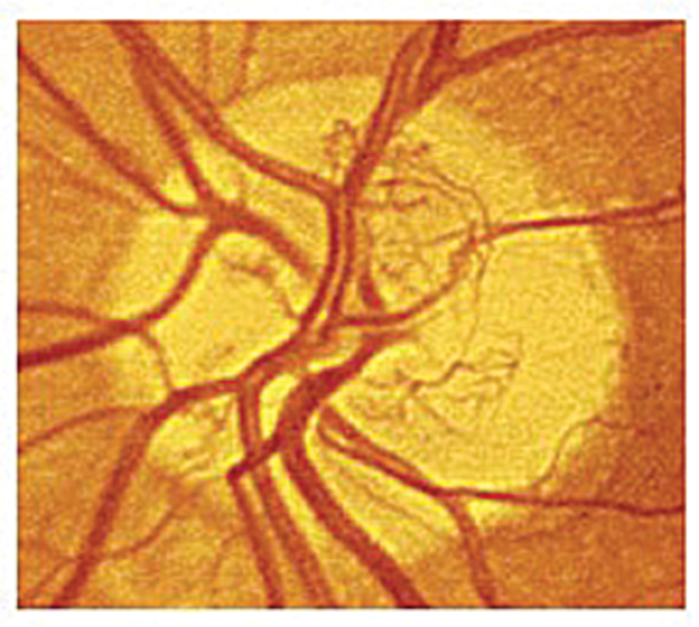 Management of proliferative diabetic retinopathy | Eye News