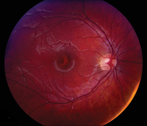 Retina burn - medijery