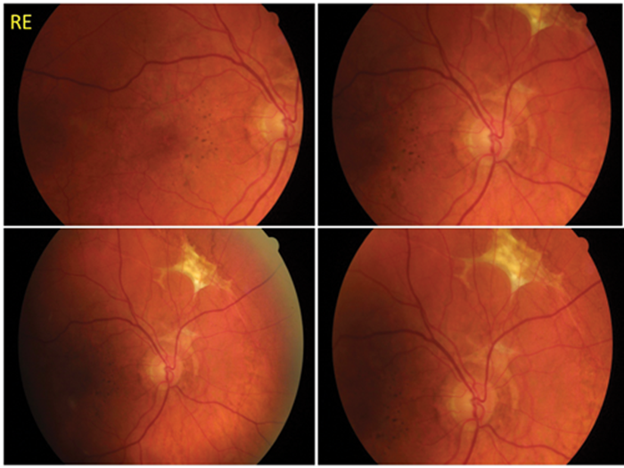 Effect of minor trauma in eyes with previously undiagnosed angioid ...