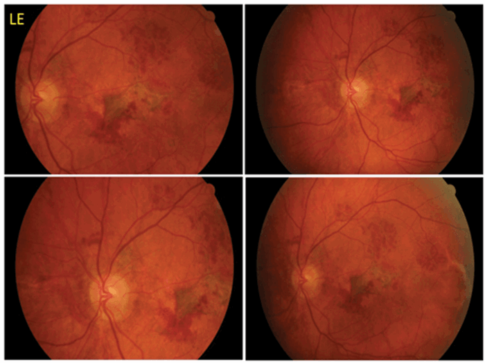 Effect of minor trauma in eyes with previously undiagnosed angioid ...