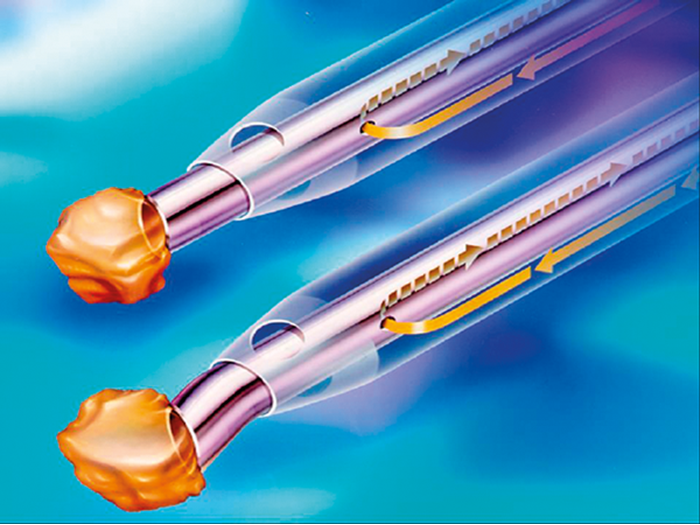 Practical phacodynamics – making the most of your phacoemulsification ...