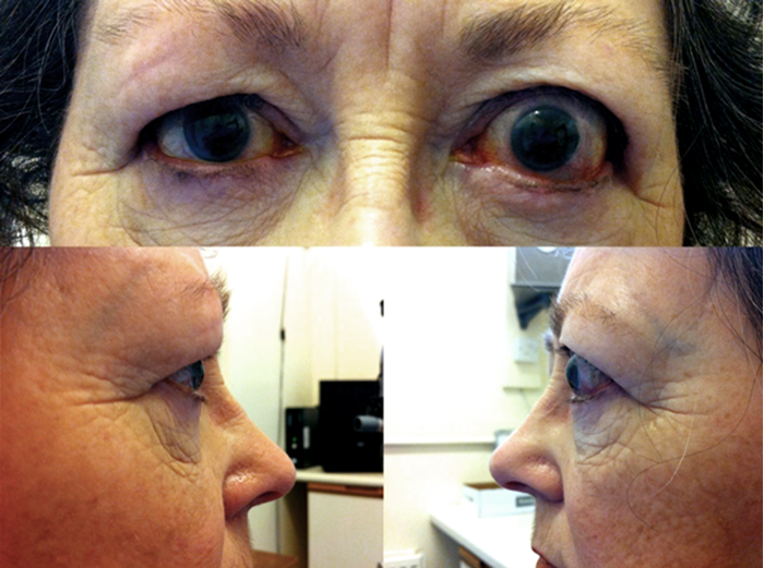 Unilateral Single Wall Decompression of Thyroid Proptosis Following an ...