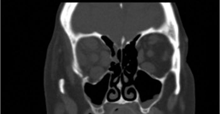 Unilateral Single Wall Decompression of Thyroid Proptosis Following an ...