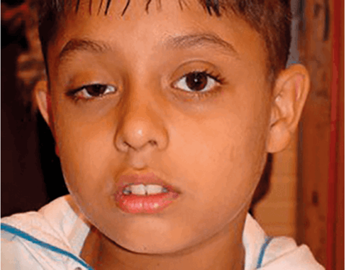 Paediatric ptosis | Eye News
