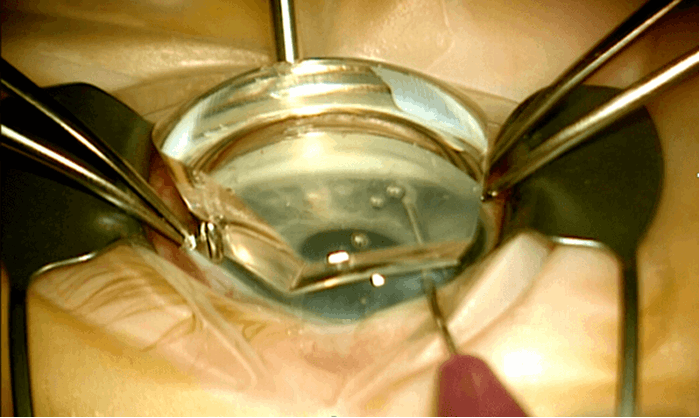 Childhood glaucoma | Eye News