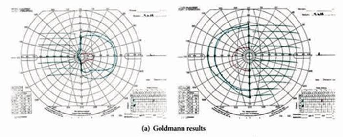 Pituitary adenoma causing compression of the optic chiasm | Eye News