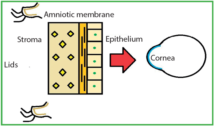 Understanding amniotic membrane grafts | Eye News