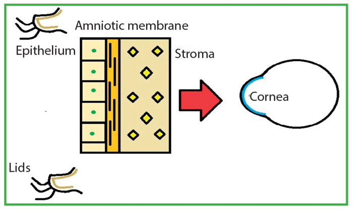 Understanding amniotic membrane grafts | Eye News
