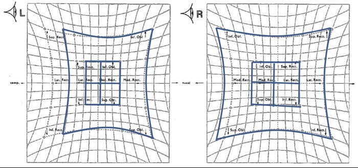 Sixth nerve palsy versus decompensating distance esophoria | Eye News
