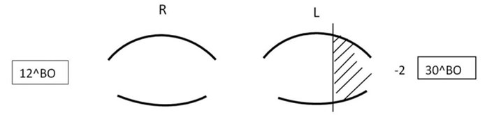 Sixth nerve palsy versus decompensating distance esophoria | Eye News