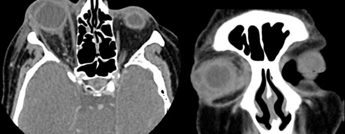 Understanding and confronting bacterial endophthalmitis | Eye News
