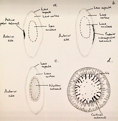 The paediatric cataract: an overview of the embryology and ...