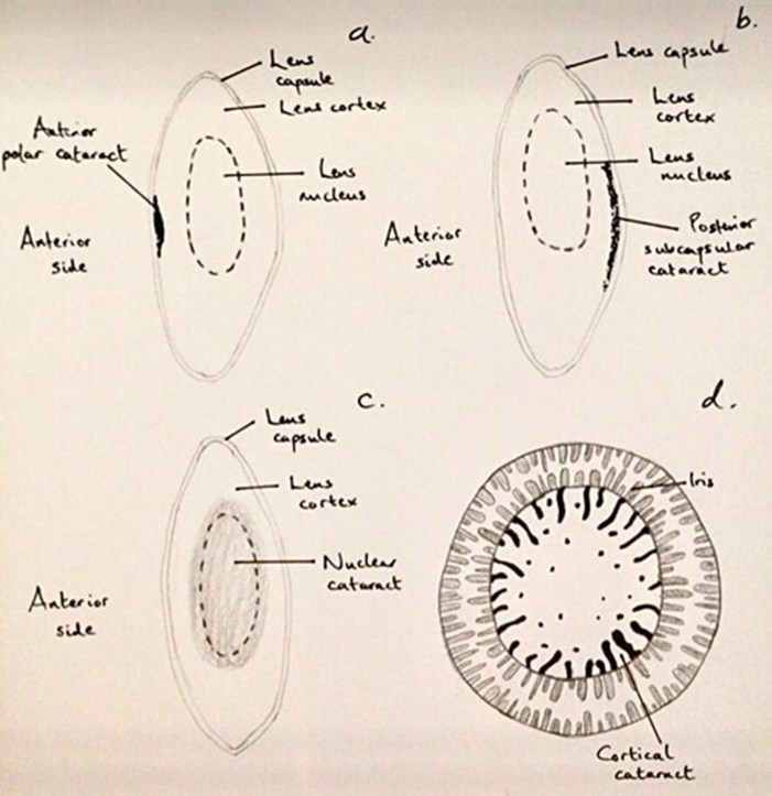 The paediatric cataract: an overview of the embryology and ...