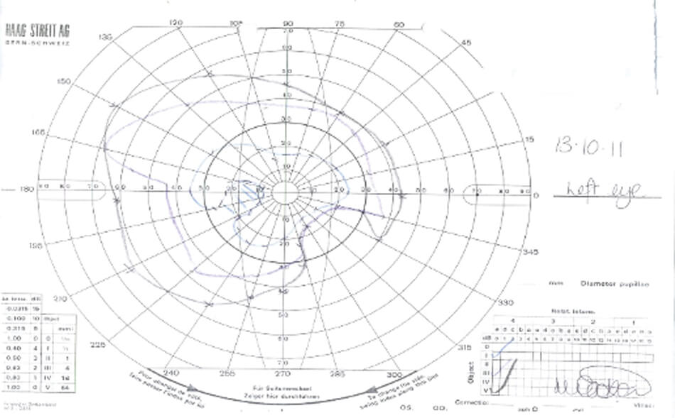 Cancer associated retinopathy | Eye News