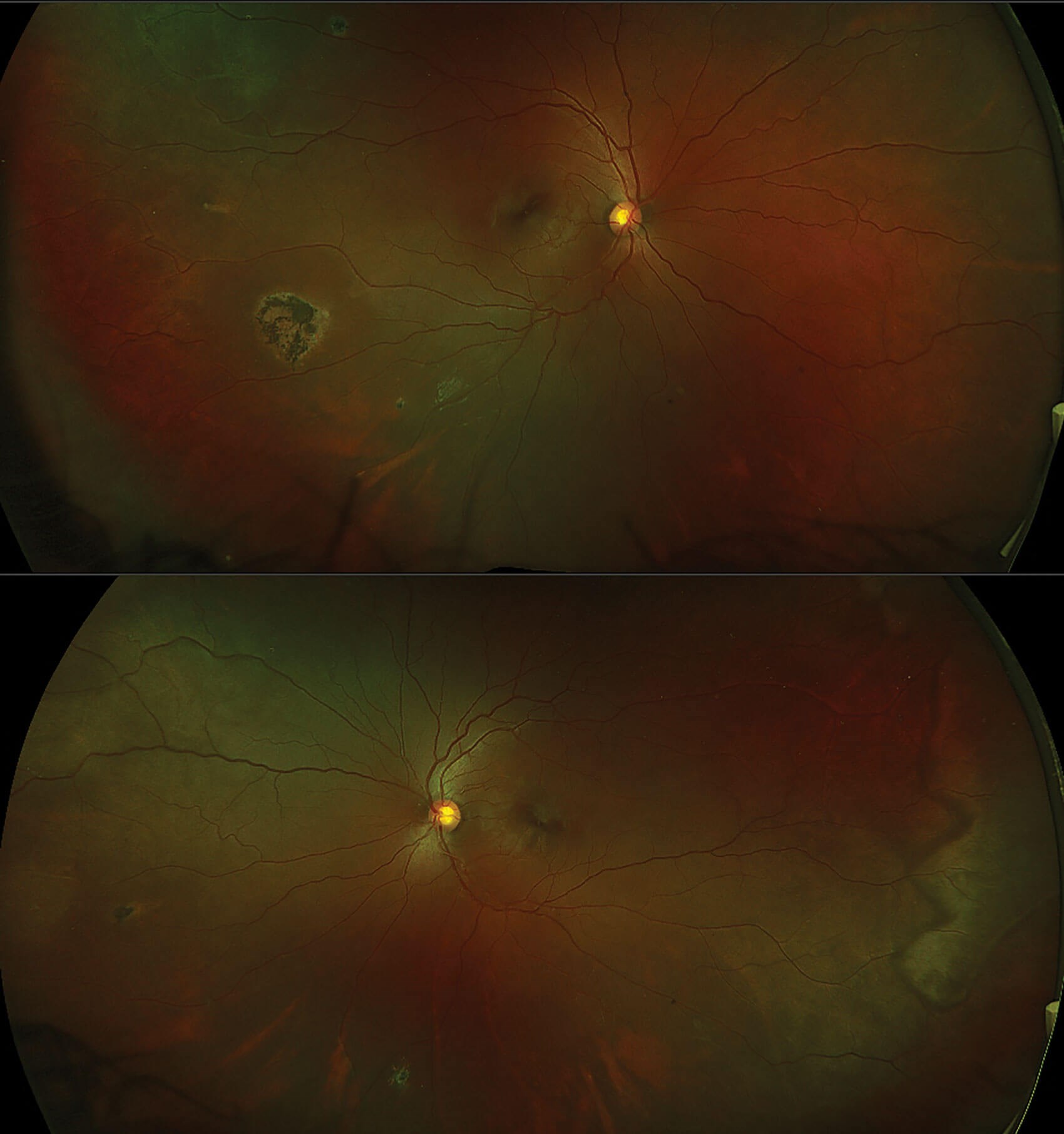 Screening for Sickle Cell Retinopathy (SCR): Why we do wide-field ...