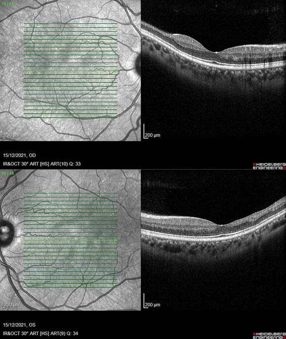 Screening for Sickle Cell Retinopathy (SCR): Why we do wide-field ...