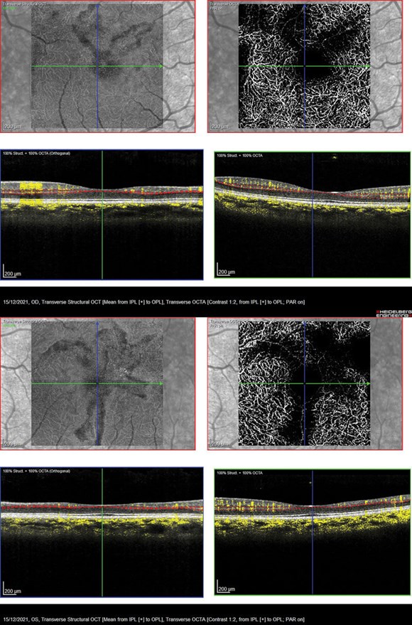 Screening for Sickle Cell Retinopathy (SCR): Why we do wide-field ...