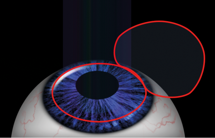 Laser corneal refractive procedures – a review | Eye News