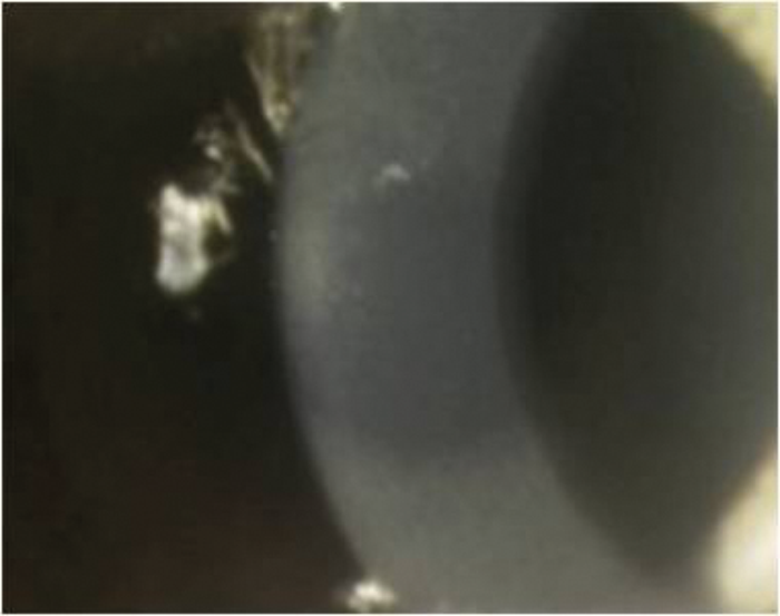 Troubleshooting in LASIK | Eye News