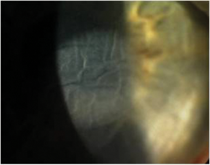 Troubleshooting in LASIK | Eye News