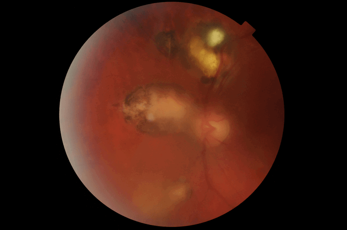 Toxoplasmosis and the associated retinochoroiditis: important facts and ...