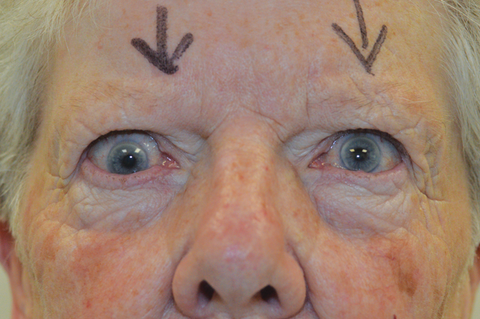 Strabismus in thyroid eye disease | Eye News